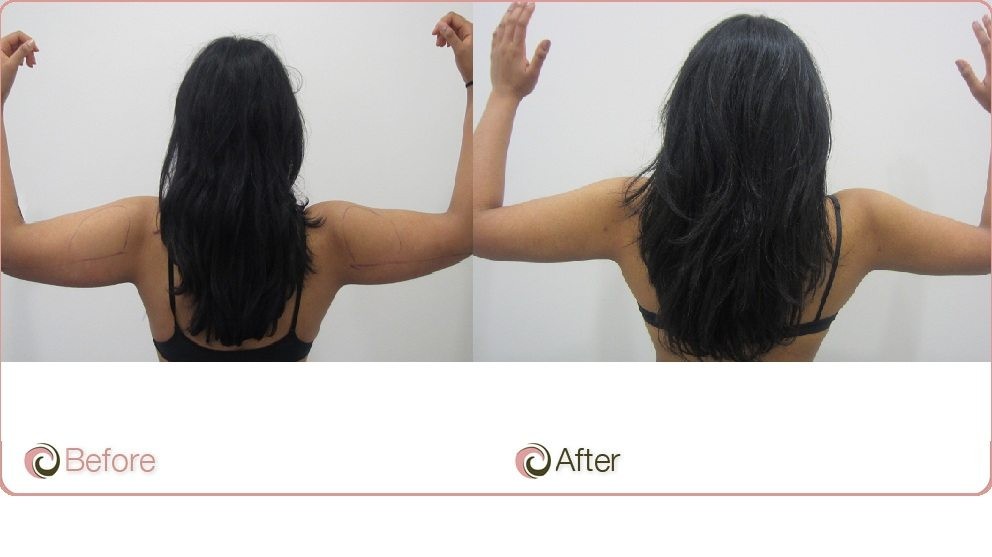 Arm Liposuction Before After Explore The Outcomes Online Arm Liposuction Before After Explore The Outcomes Online