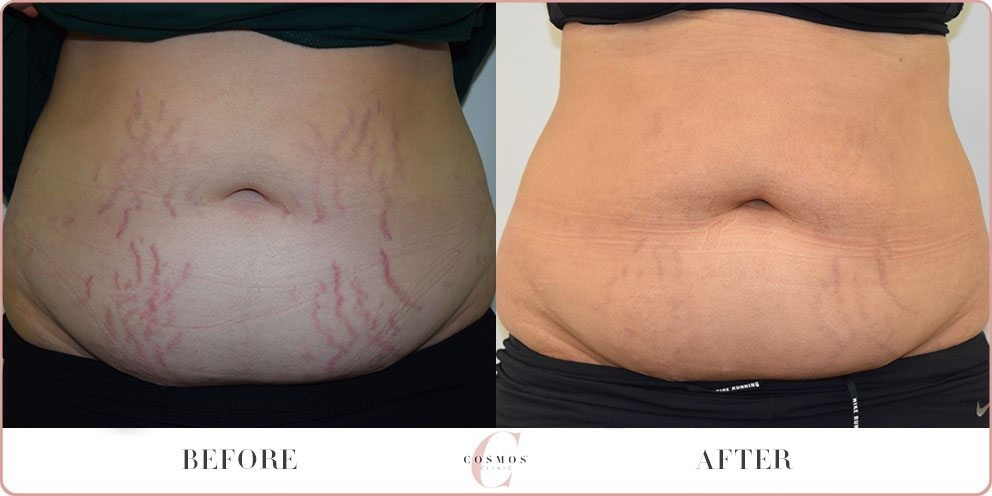 Stretch Marks Before And After Stretch Marks Before And After